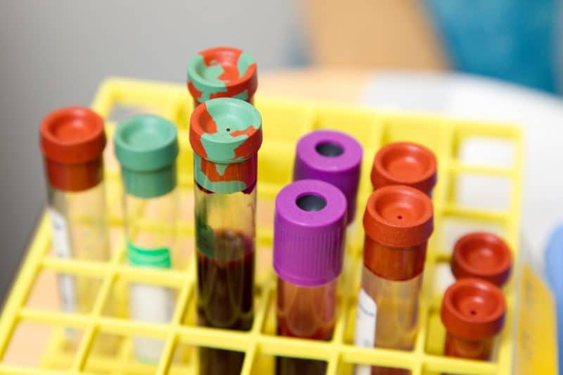 New Blood Test Could Lead to Easier FTD Diagnosis | AFTD